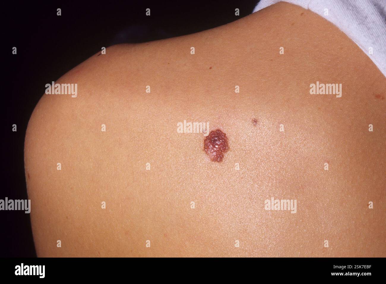 MODEL RELEASED. Mole on the left shoulder of a 29-year-old woman. Also ...