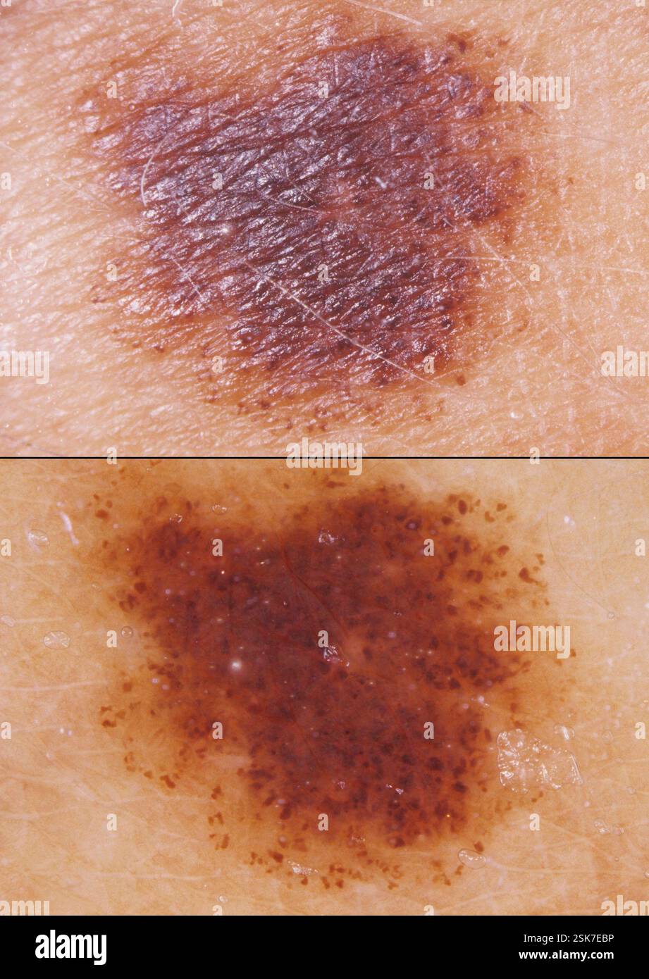 MODEL RELEASED. Mole with dermatoscope view (bottom), close-up. This ...