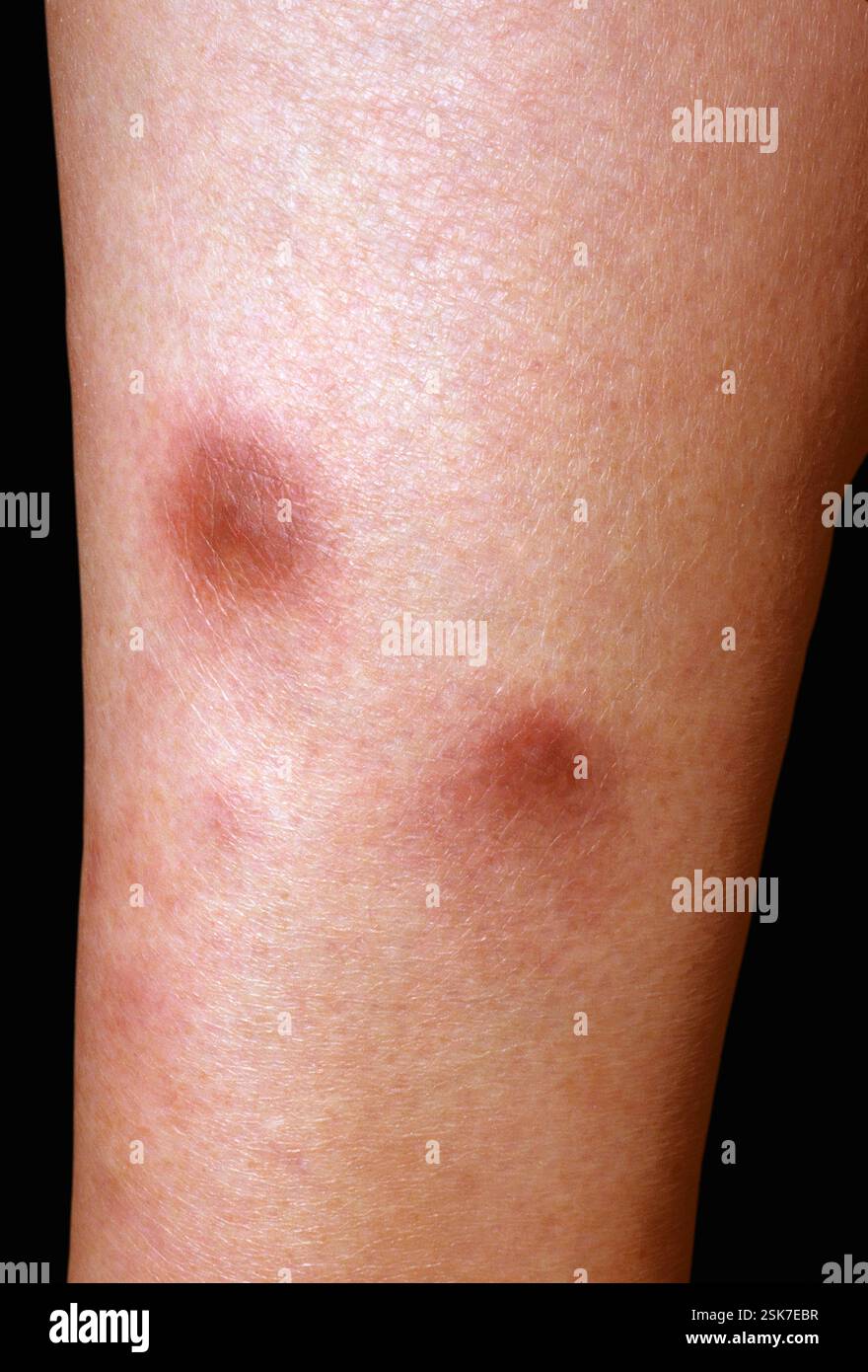 MODEL RELEASED. Erythema nodosum rash (dark areas) on a 42-year-old ...