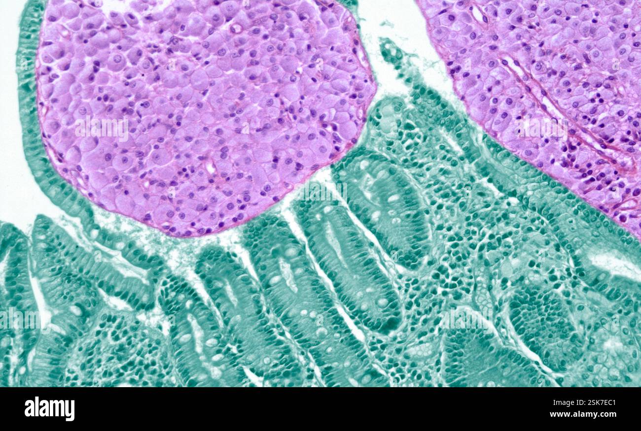 Whipple's disease in the colon, light micrograph. Intestinal tissue in ...