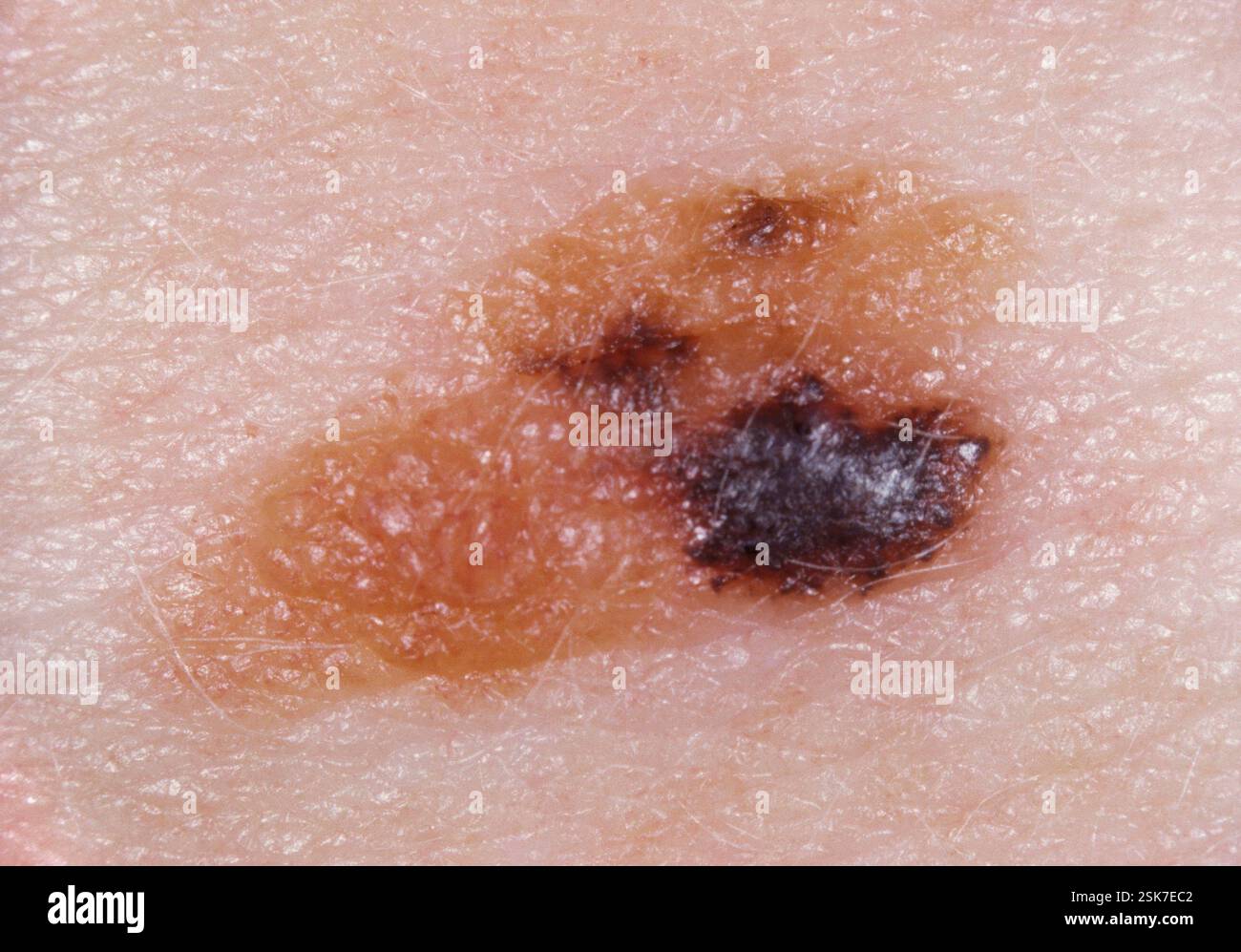 MODEL RELEASED. Malignant melanoma on the skin of a 39-year-old man. Melanoma is a form of skin ...
