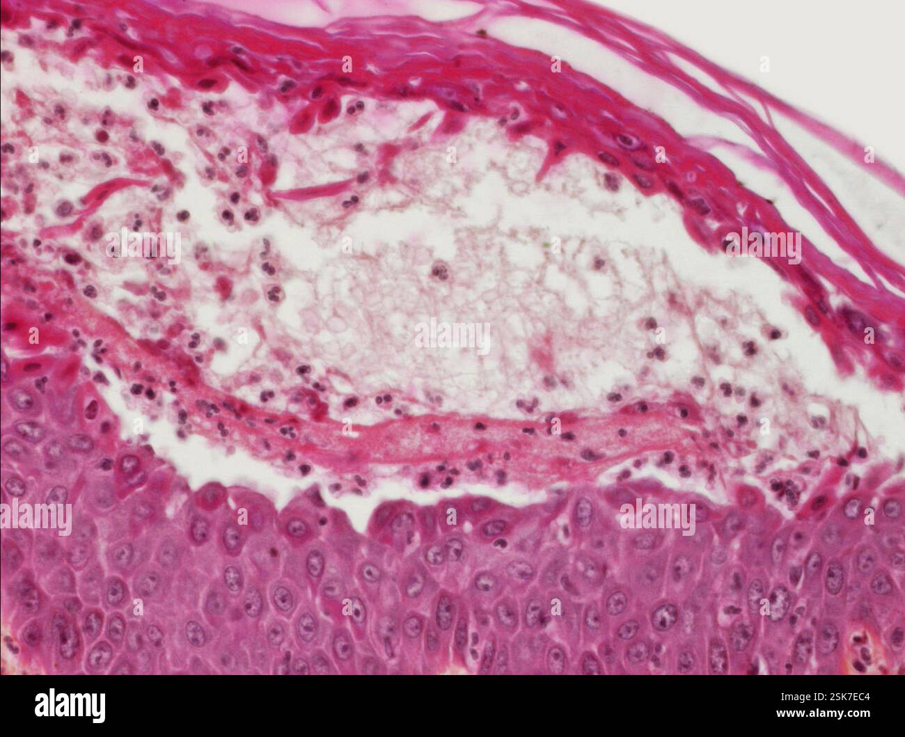 Impetigo skin pustule, light micrograph of a section through skin ...