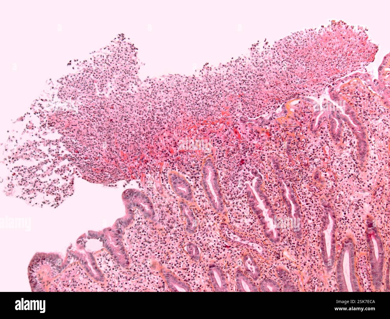 Pseudomembranous colitis. Light micrograph of a section through colon ...