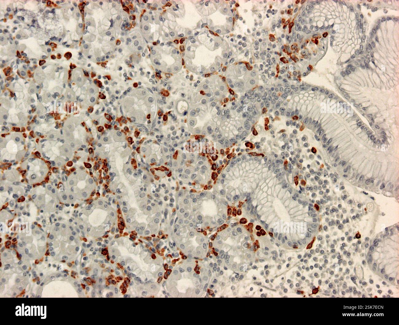 Mastocytosis in intestinal tissue, light micrograph. This is a rare ...