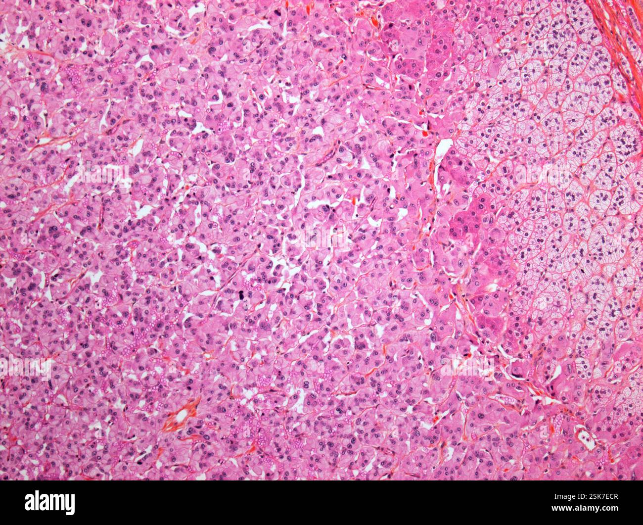 Pheochromocytoma adrenal gland tumour. Light micrograph of a section ...