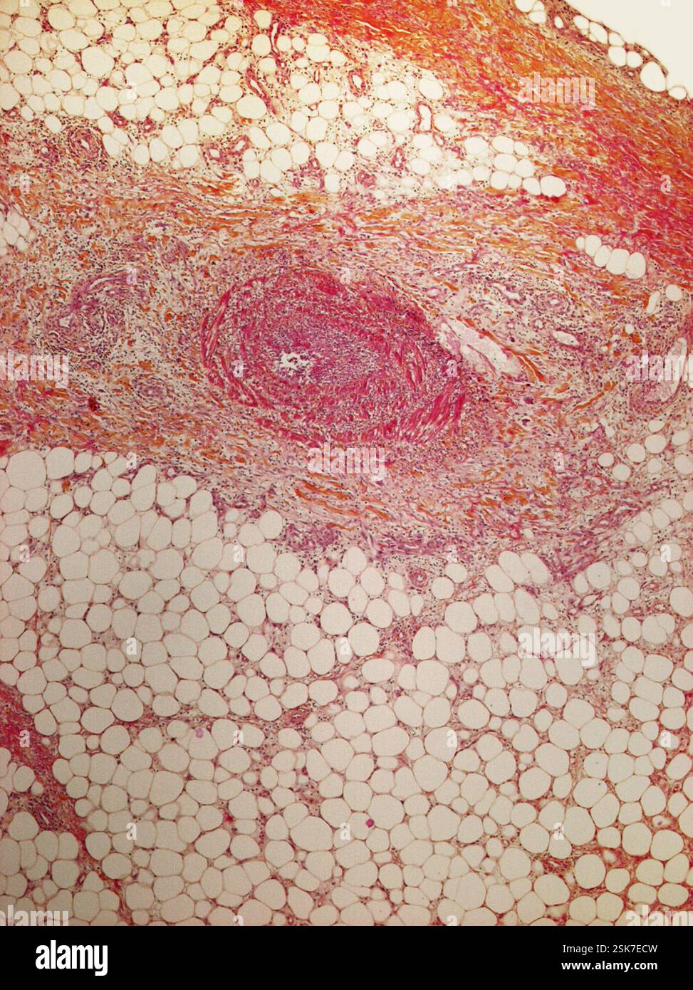 Polyarteritis nodosa (necrotizing vasculitis). Light micrograph of a ...