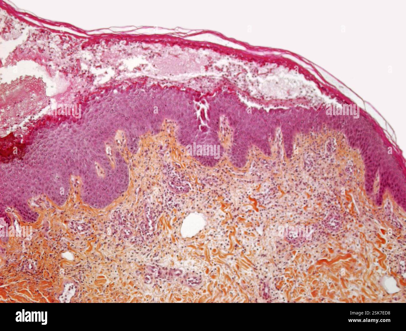 Impetigo skin pustule, light micrograph of a section through skin ...