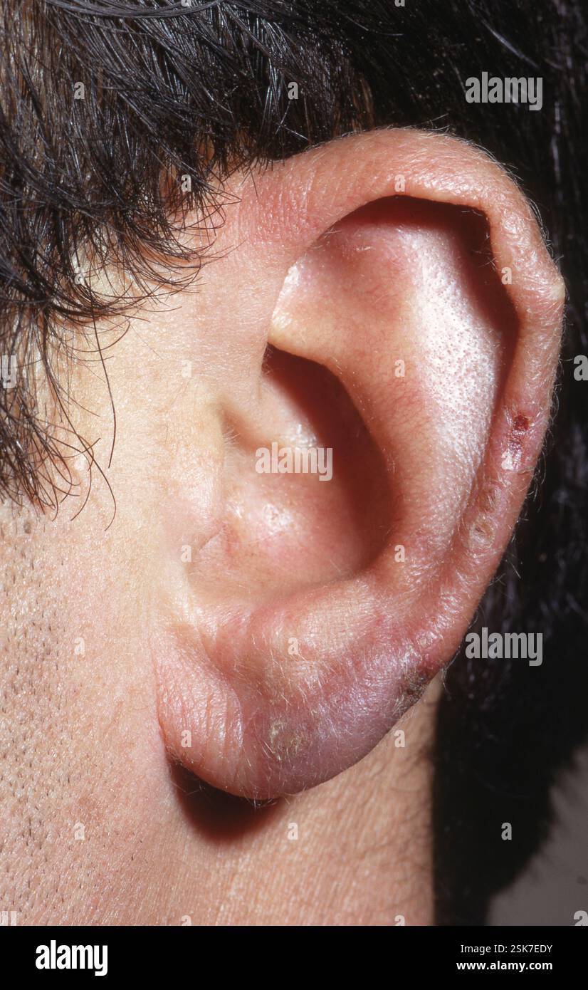 Lupus erythematosus. Close-up of a rash on the ear of a 30 year old ...