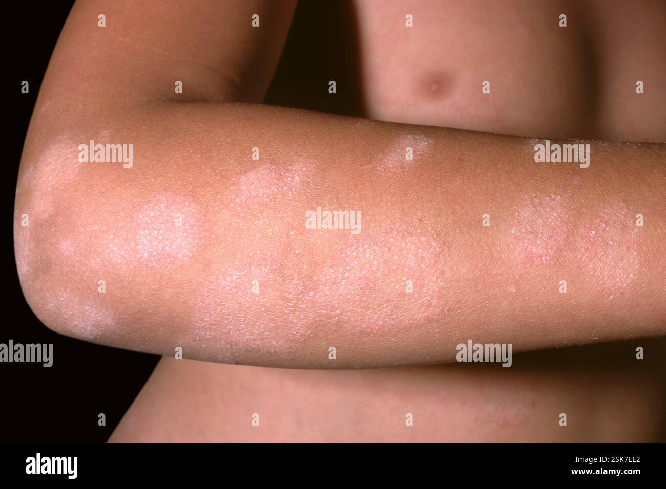 Pityriasis rosea rash on the arm of an 11 year old boy. This skin ...
