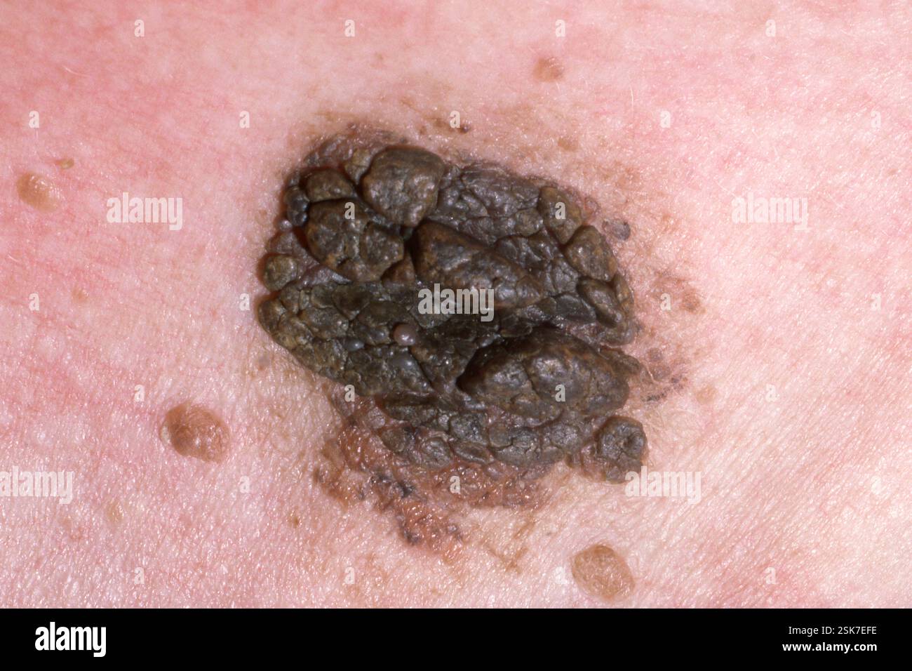 Papillomatous naevus, or mole, on the skin of a 54 year old female ...