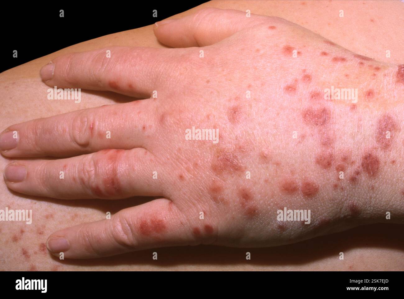 Allergic vasculitis of the hand in a 30 year old female patient. This ...