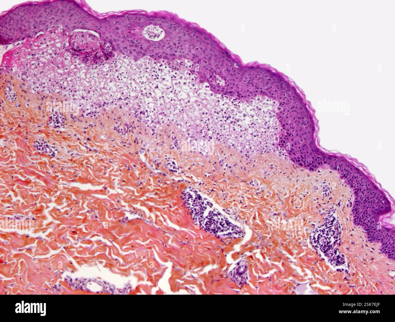 Light micrograph of a section through skin affected by dermatitis ...