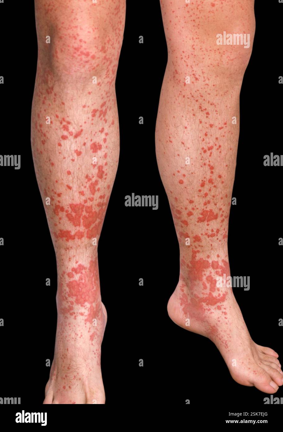 Purpura rash on the lower legs of a 34 year old male patient. Purpura ...