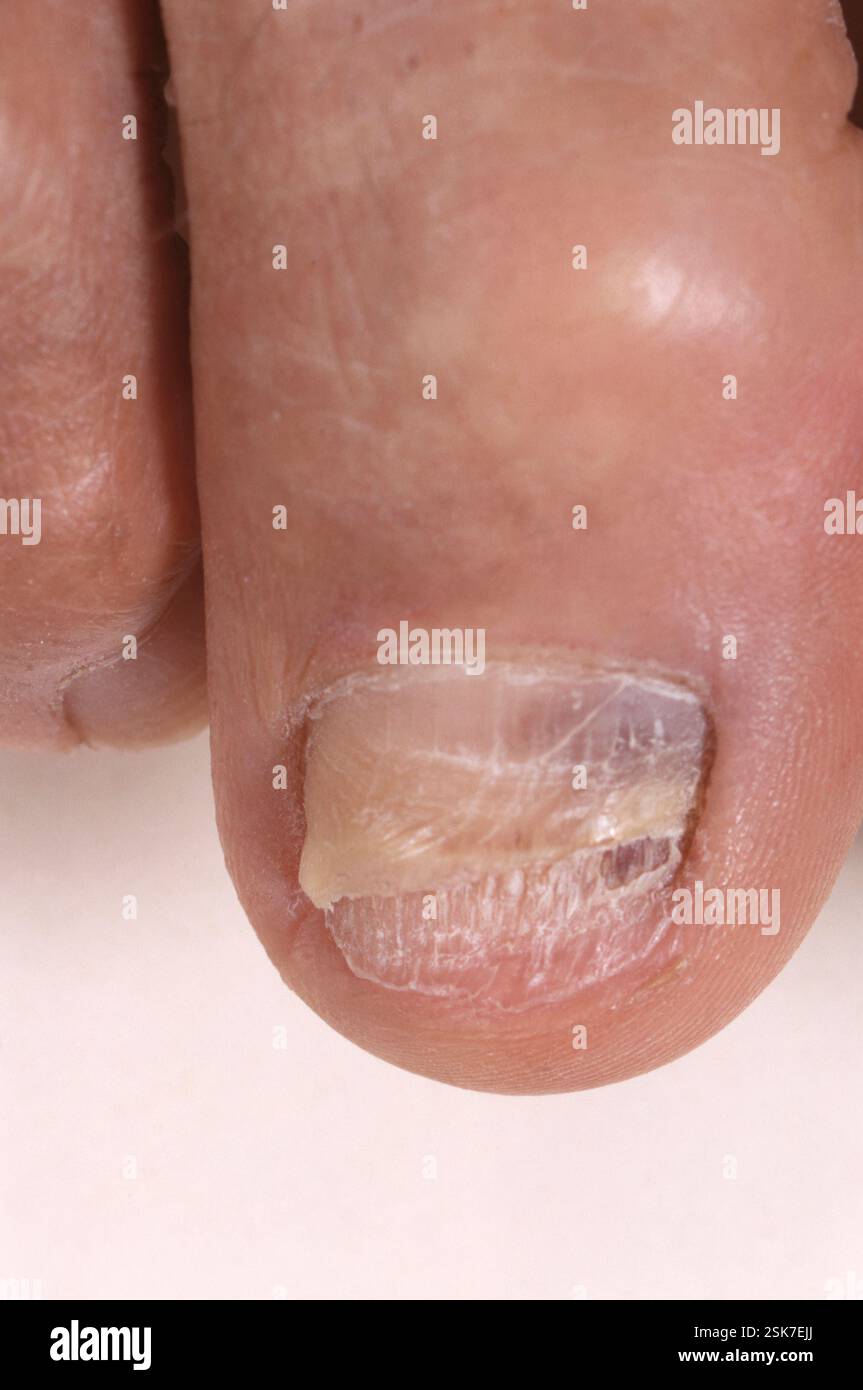 Toenail of a 25 year old woman with a fungal infection. Known as ...