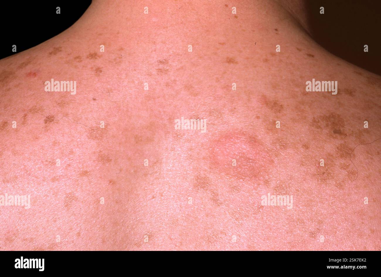 Inflamed and scaly skin on the back of a 28 year old man with ...