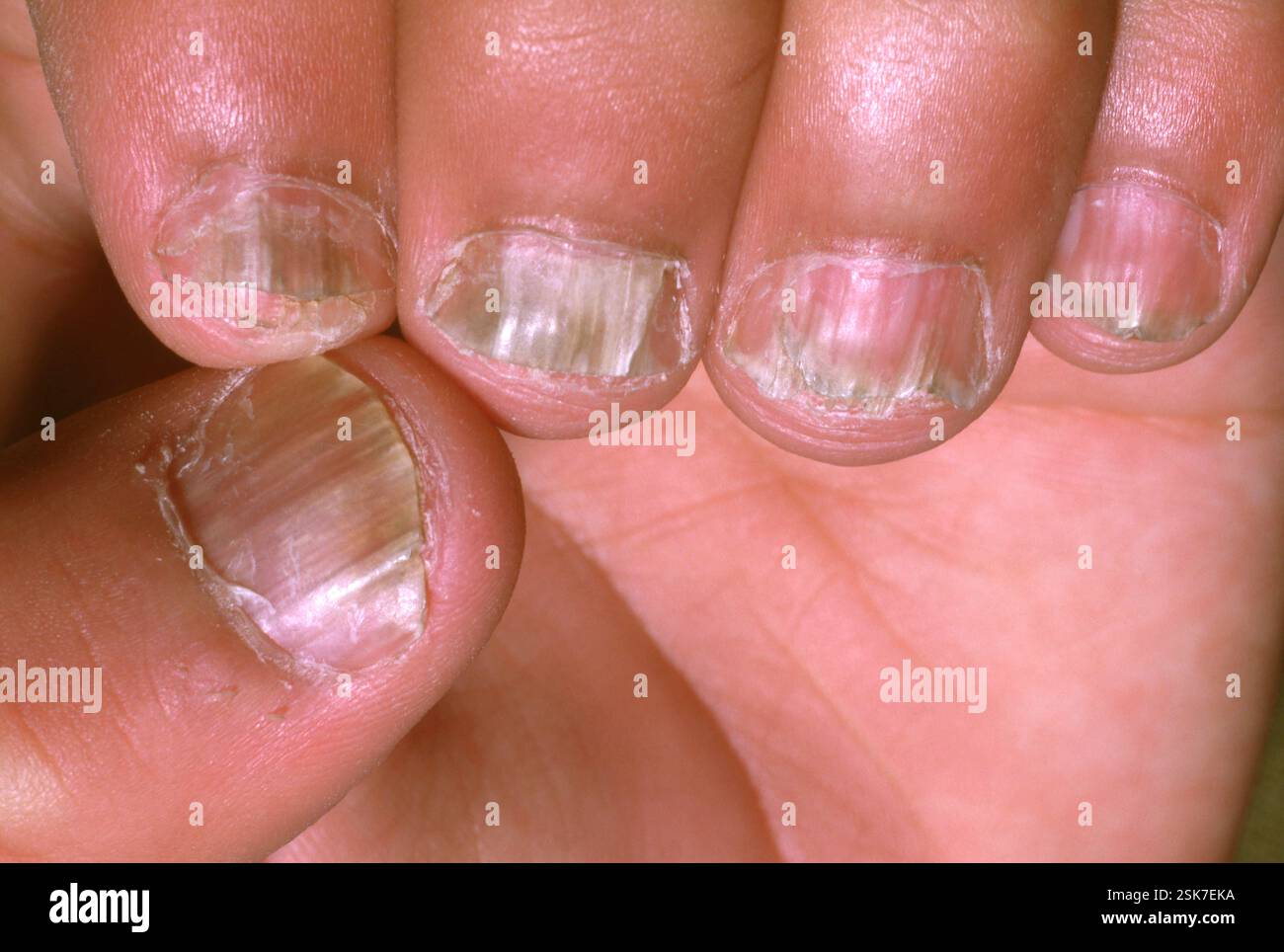 Fingernails of a 50 year old man with onychodystrophy, or abnormality ...