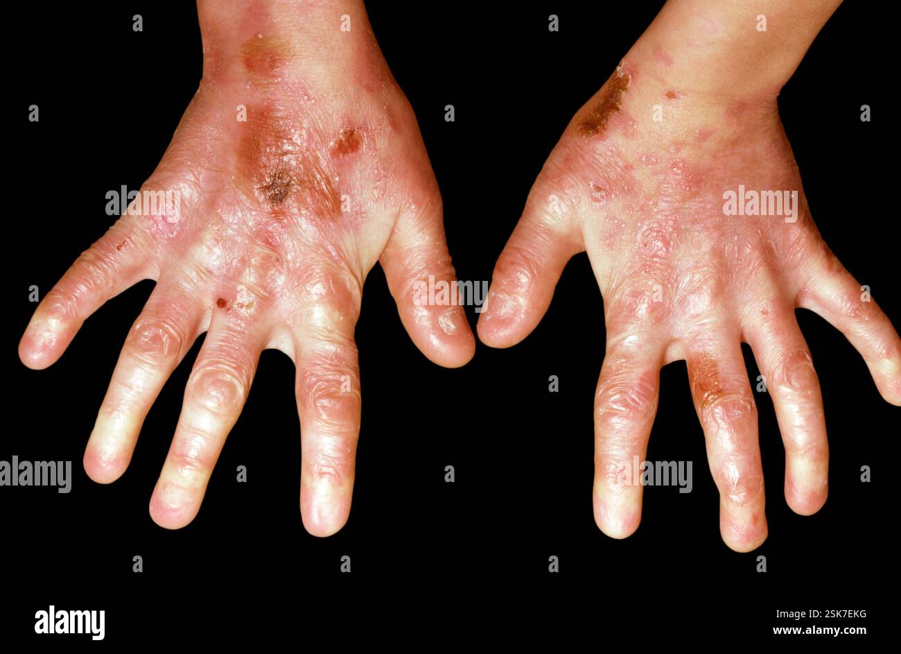 Epidermolysis bullosa (EB) blisters on the hands of a 30 year old woman ...