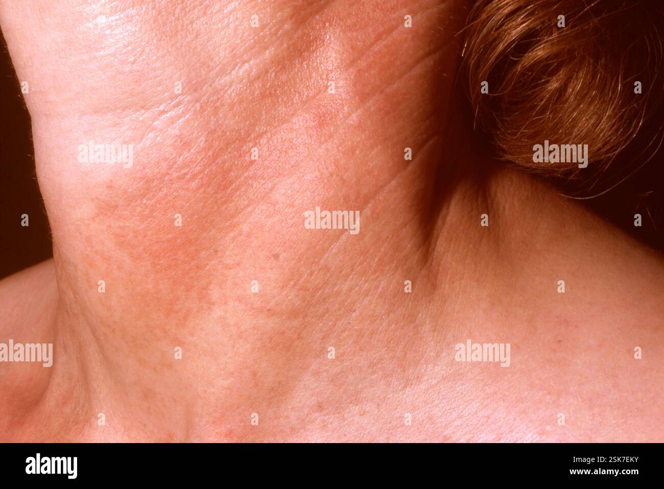 Rash on the neck of a 61 year old female patient with Poikiloderma of ...
