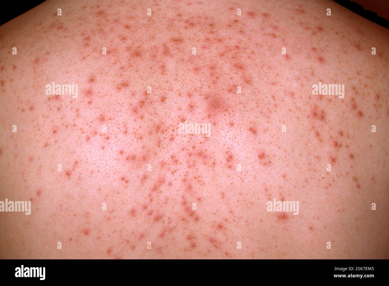 Prickly heat blisters on the back of a 32 year old man. This is a mild ...