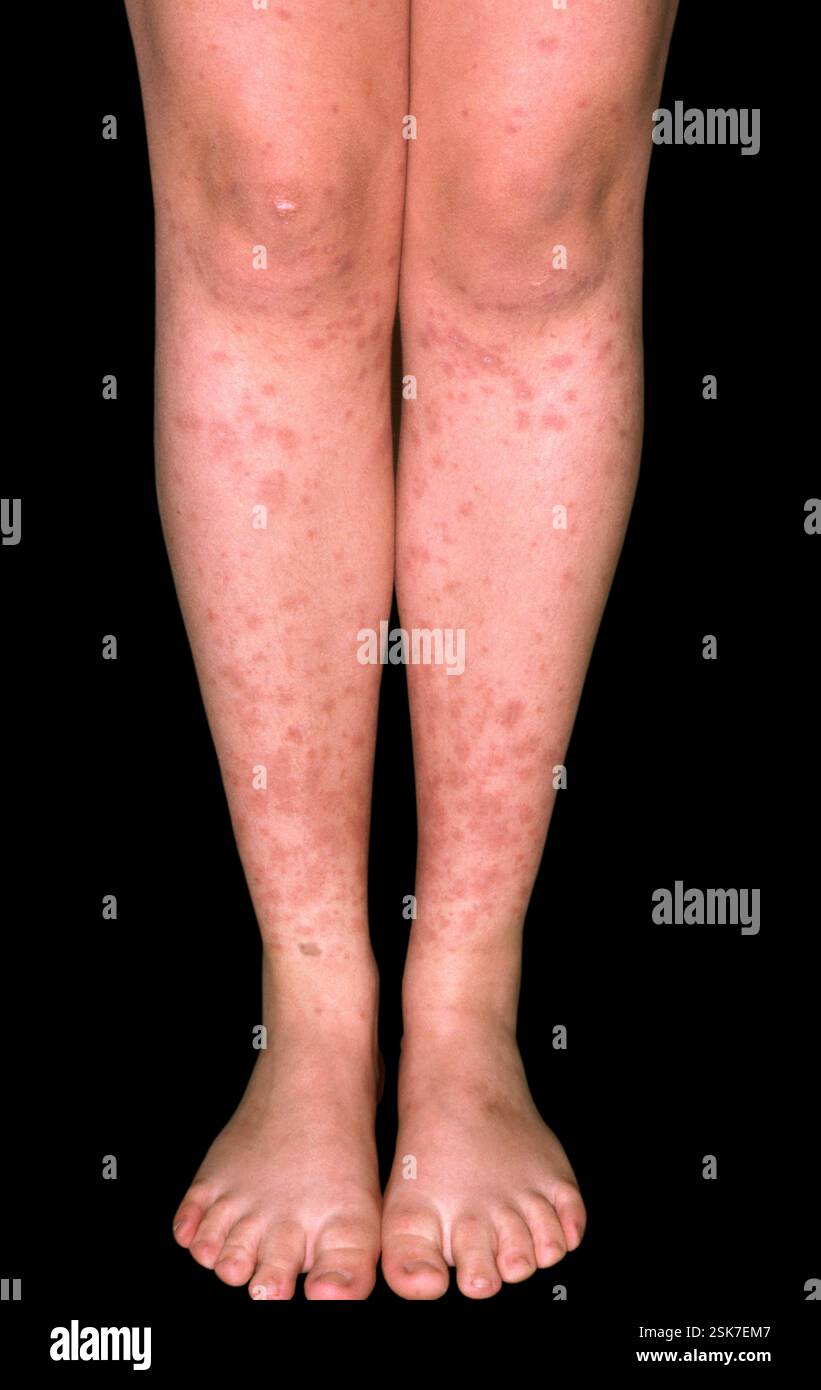 Infectious mononucleosis (glandular fever) rash on the legs of a 15 year old girl. This acute ...