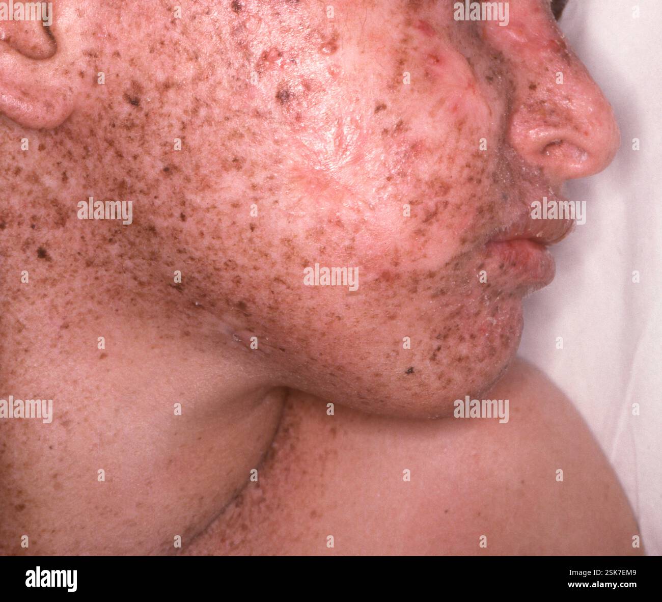 Face of a 7 year old male patient with xeroderma pigmentosum (XP). XP ...