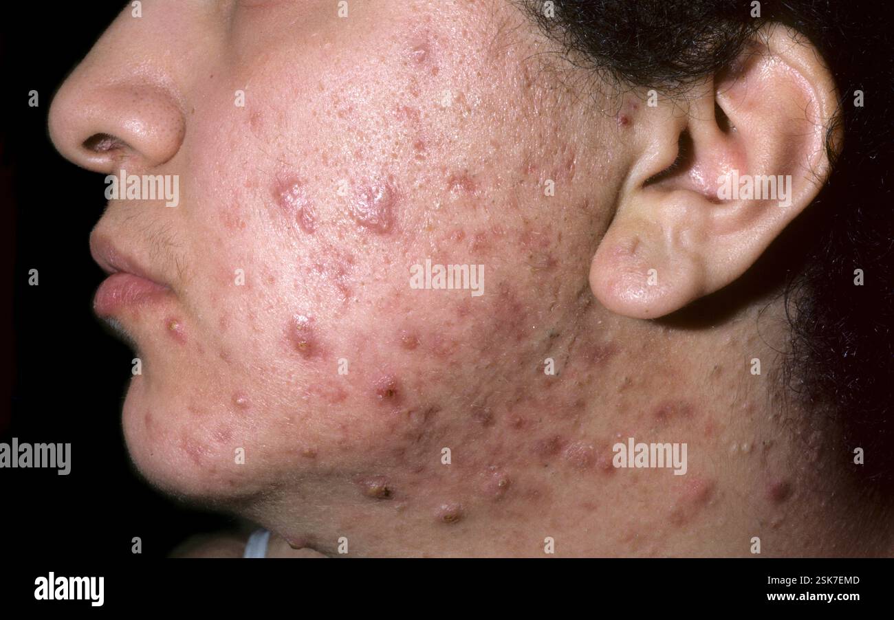 Nodulocystic acne on the face of a 28 year old male patient. This is a ...