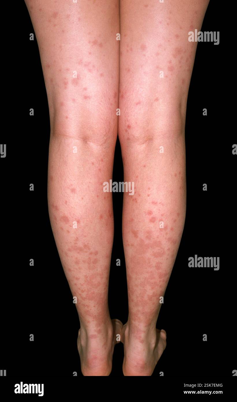 Infectious mononucleosis (glandular fever) rash on the legs of a 15 year old girl. This acute ...