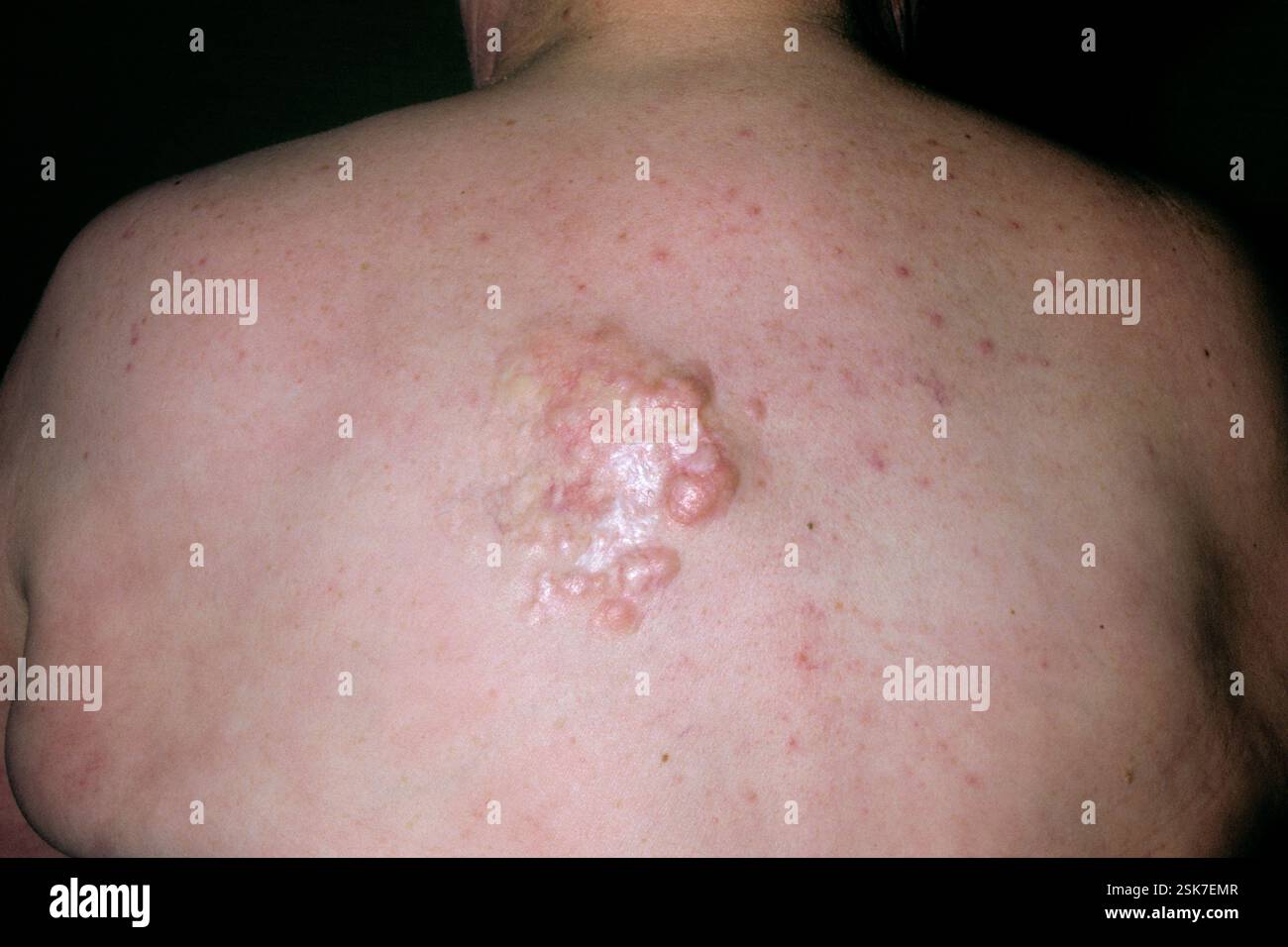 Dermatofibrosarcoma protuberans (DFSP) tumour on the back of a 60 year ...