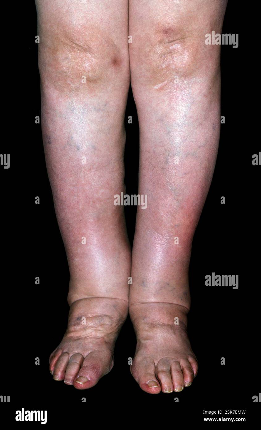 Swollen legs of a 62 year old female patient affected by lymphoedema ...