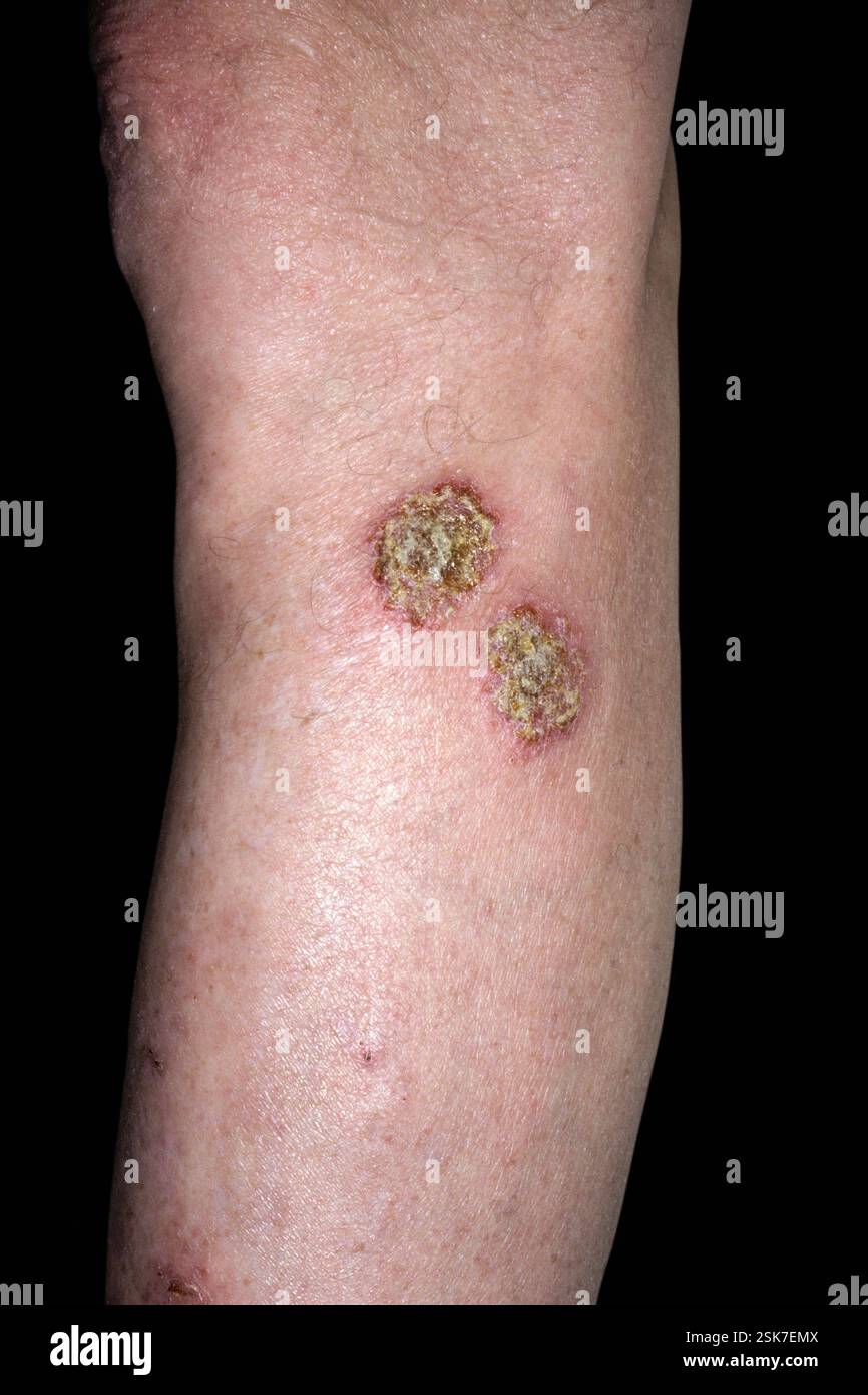 Infected discoid eczema on the leg of a patient. Eczema is an ...