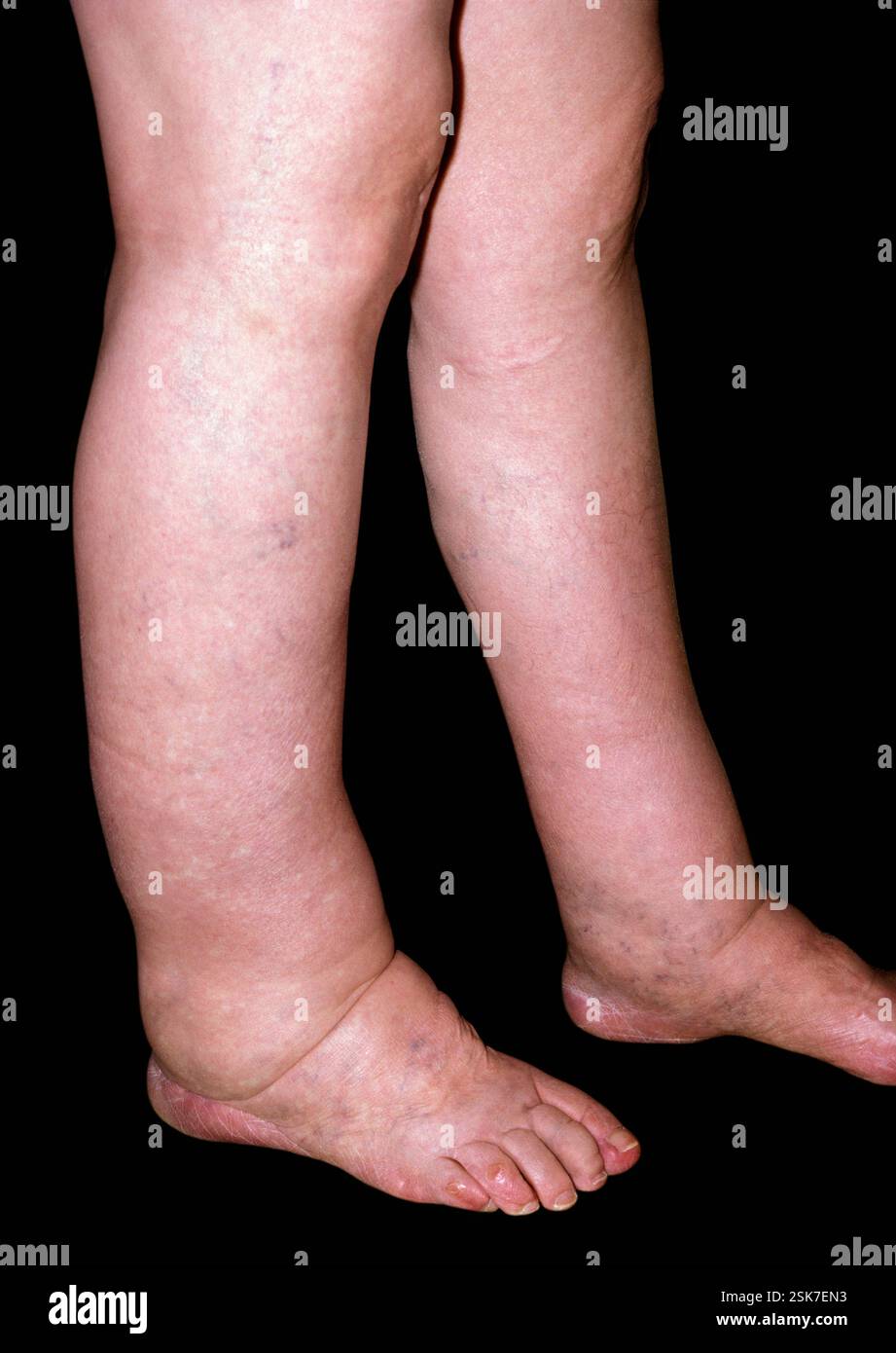 Swollen legs of a 62 year old female patient affected by lymphoedema ...