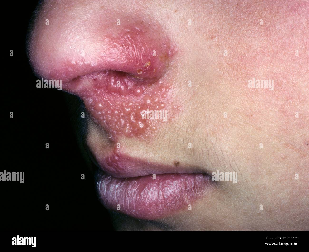 Bullous eczema around the nose of a male patient. Eczema is a form of chronic inflammation of ...