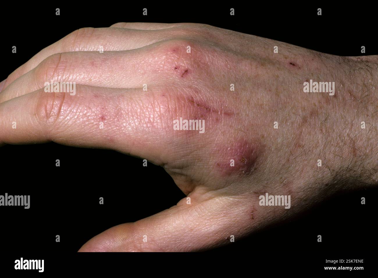Cat scratch disease on the hand of a male patient. The bumps on the hand are caused by infection ...