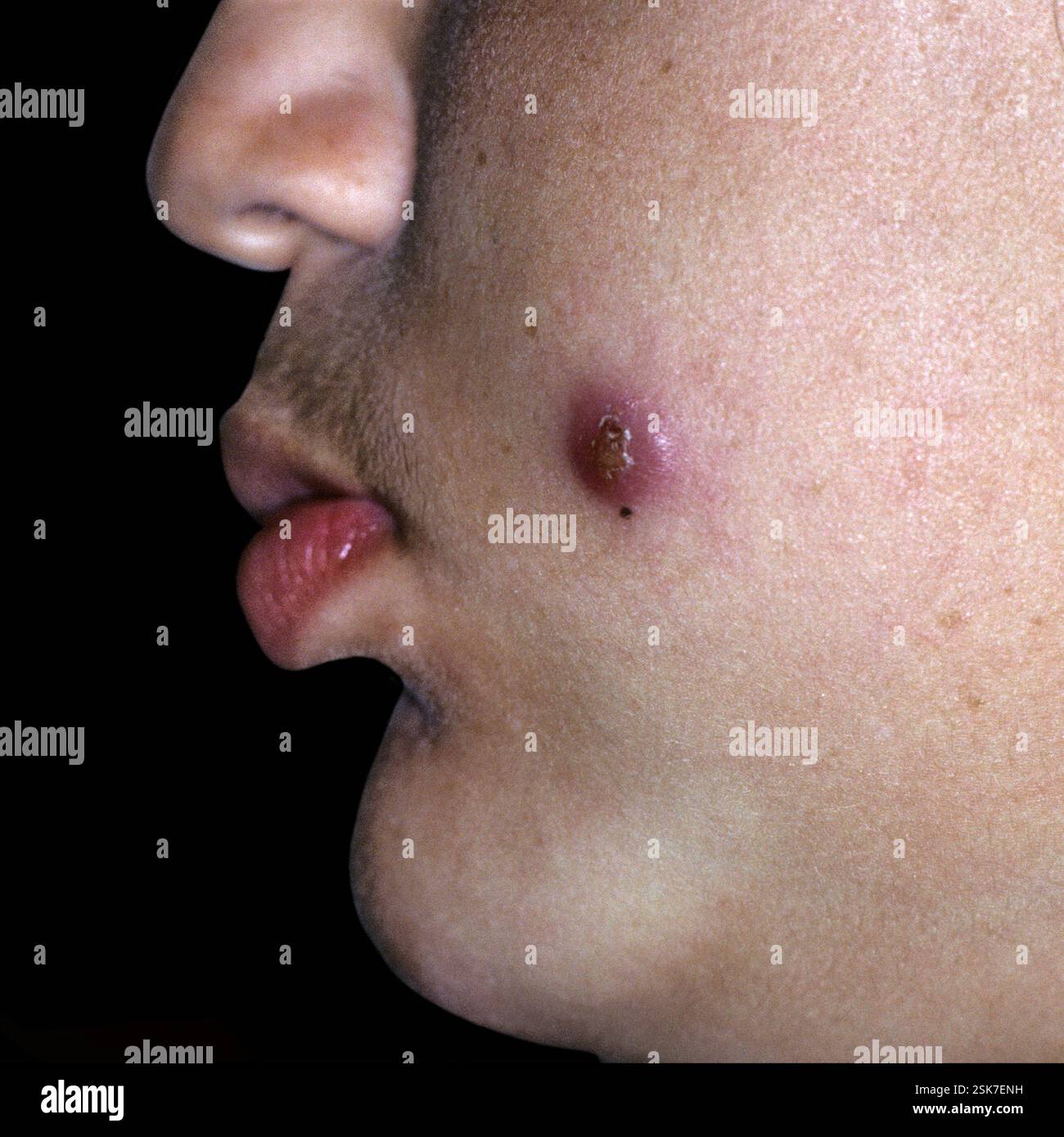 Lesion on the cheek of a 15 year old boy with Langerhans cell ...