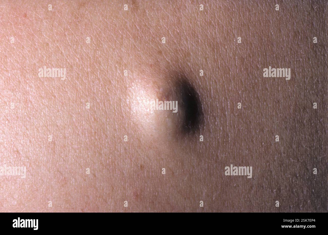 Close-up of a sebaceous cyst under the skin. Cysts are pus-filled ...