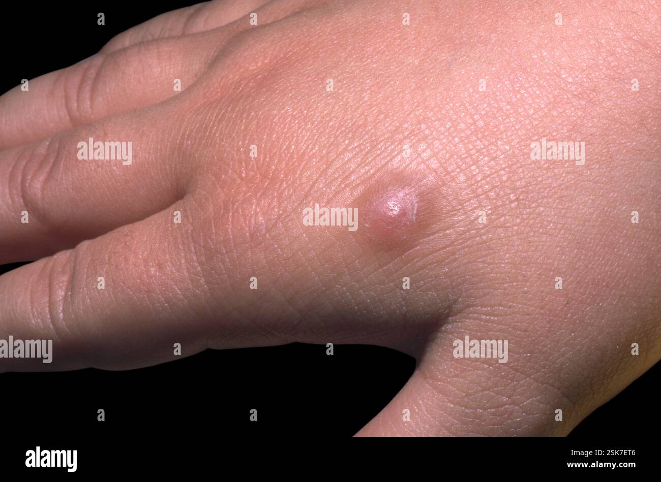 Molluscum contagiosum. Close-up of an infected papule on the hand of an ...