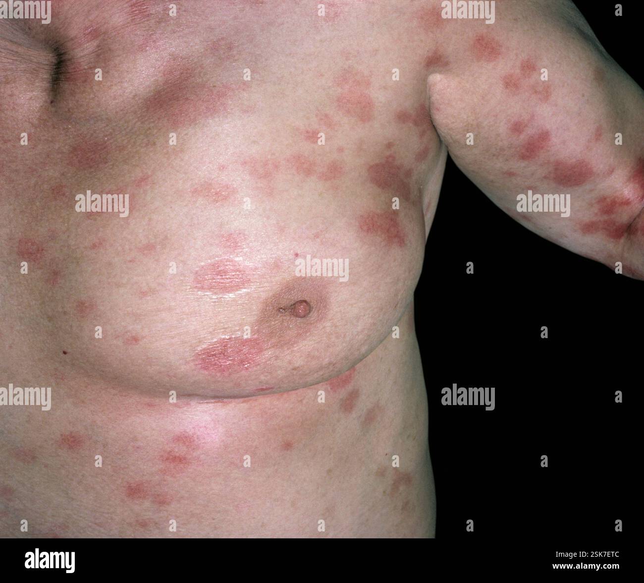 Mycosis fungoides lesions on the chest and arm of a female patient ...