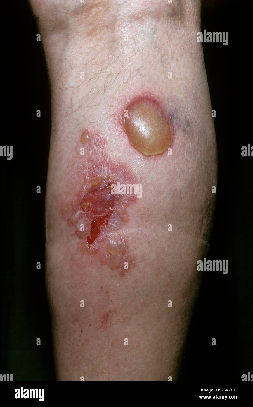 Bullous pemphigoid blisters on the leg of a male patient. This ...