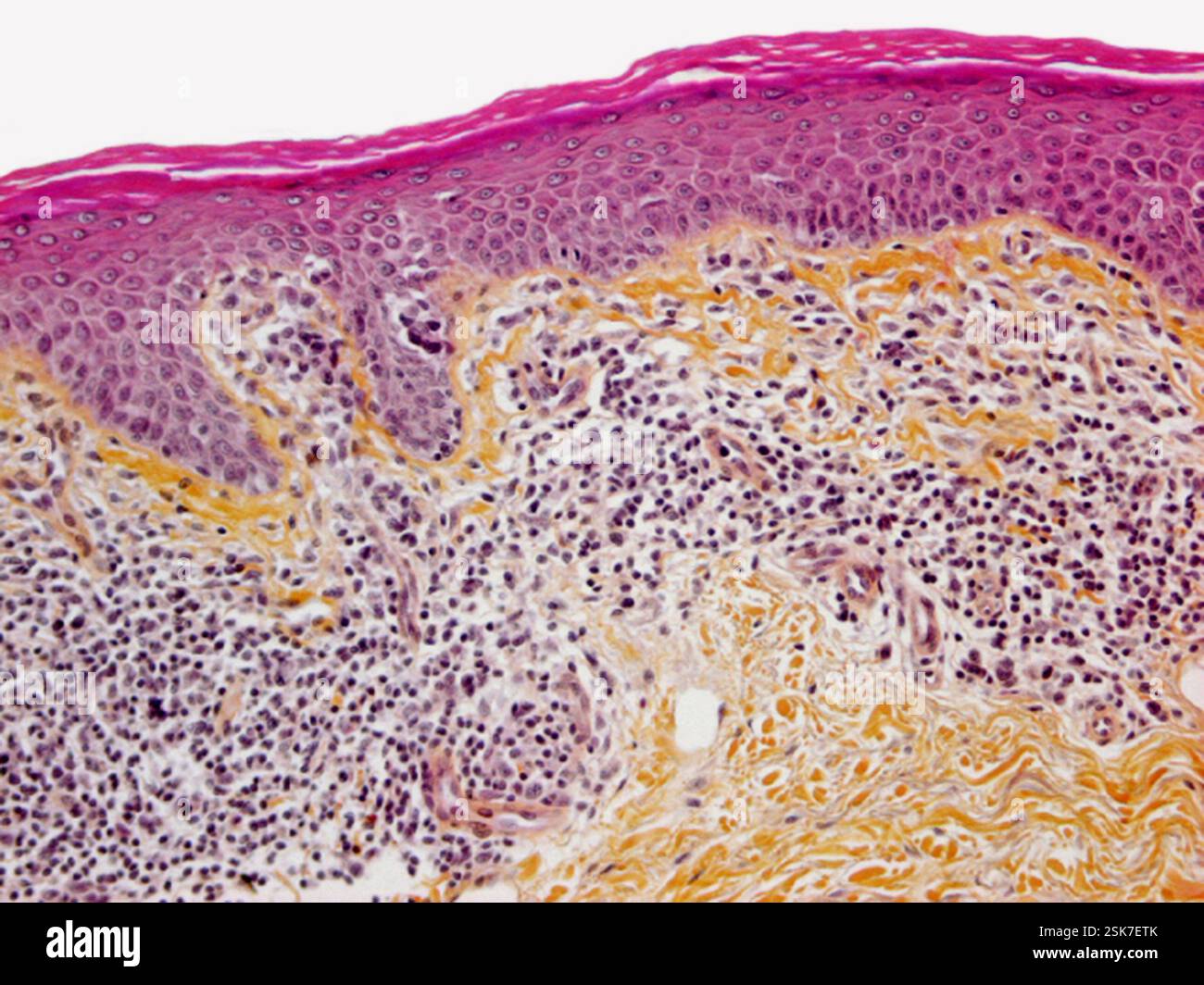 Light micrograph of a section through the skin of a patient with Sezary ...