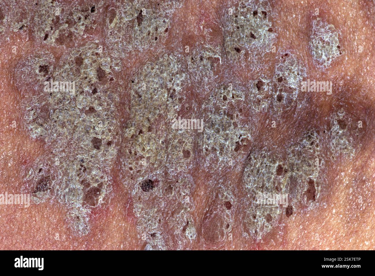 Seborrhoeic pemphigus lesions on the back of a female patient ...