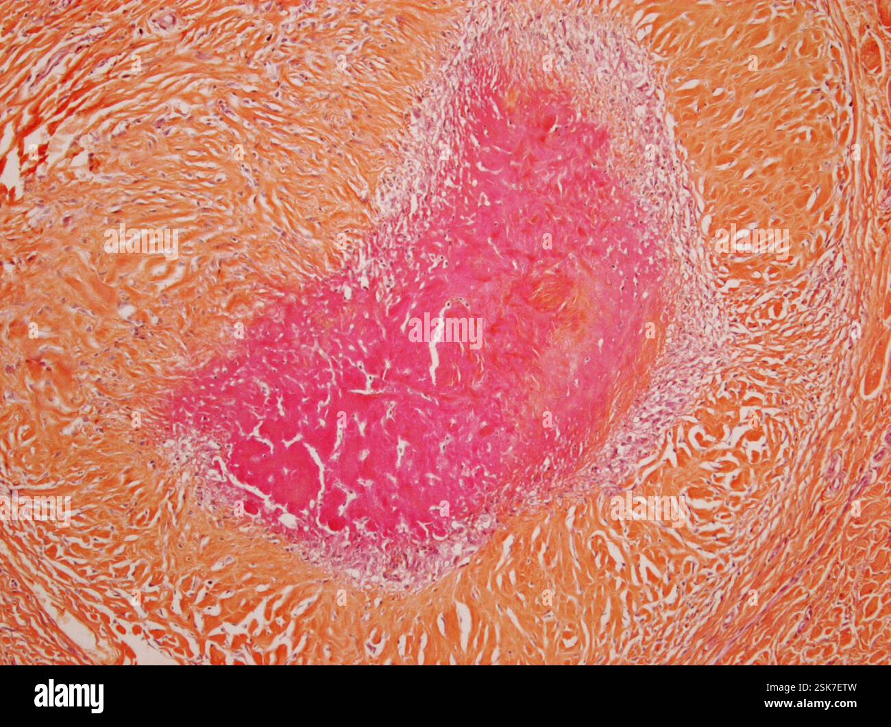 Rheumatoid arthritis. Light micrograph of a section through a ...
