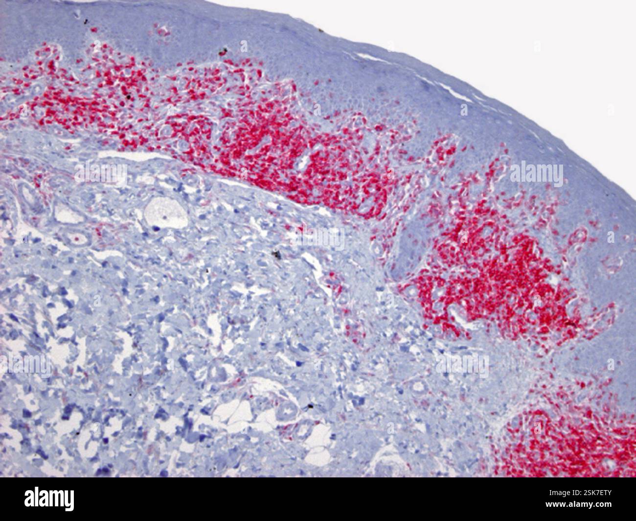 Light micrograph of a section through the skin of a patient with Sezary ...