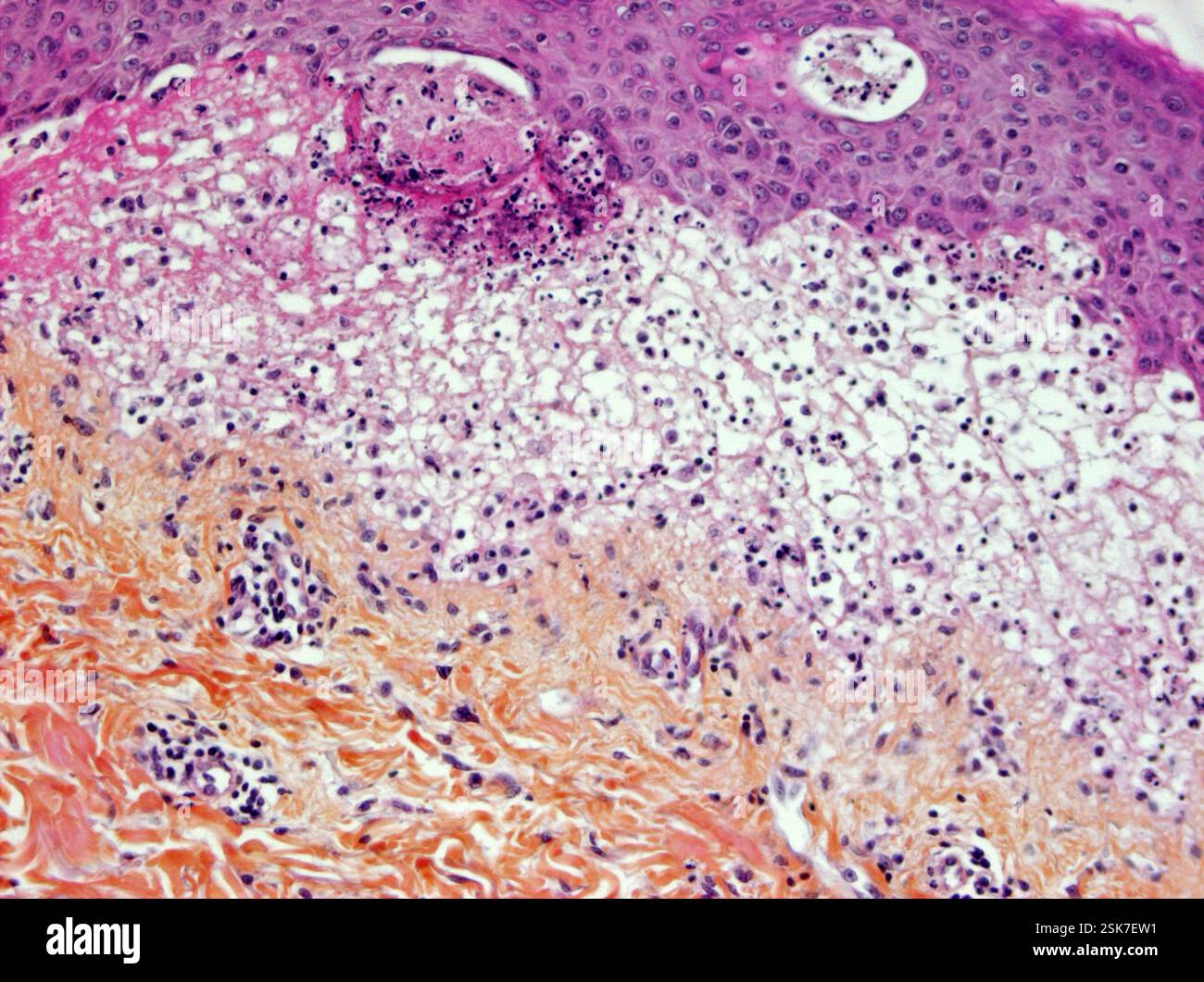 Light micrograph of a section through skin affected by dermatitis ...
