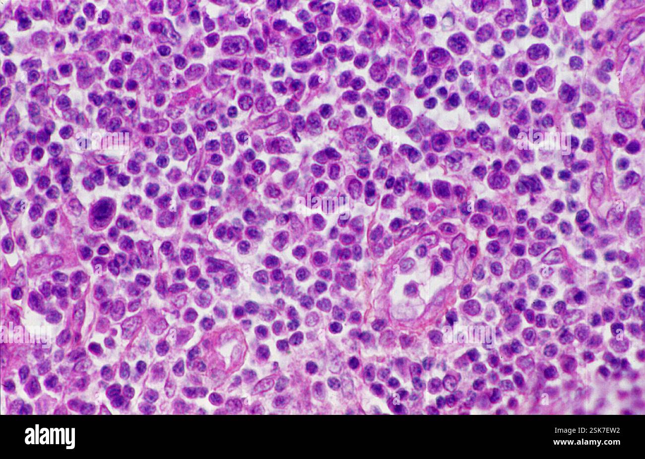 Light micrograph of a section through the skin of a patient with Sezary ...