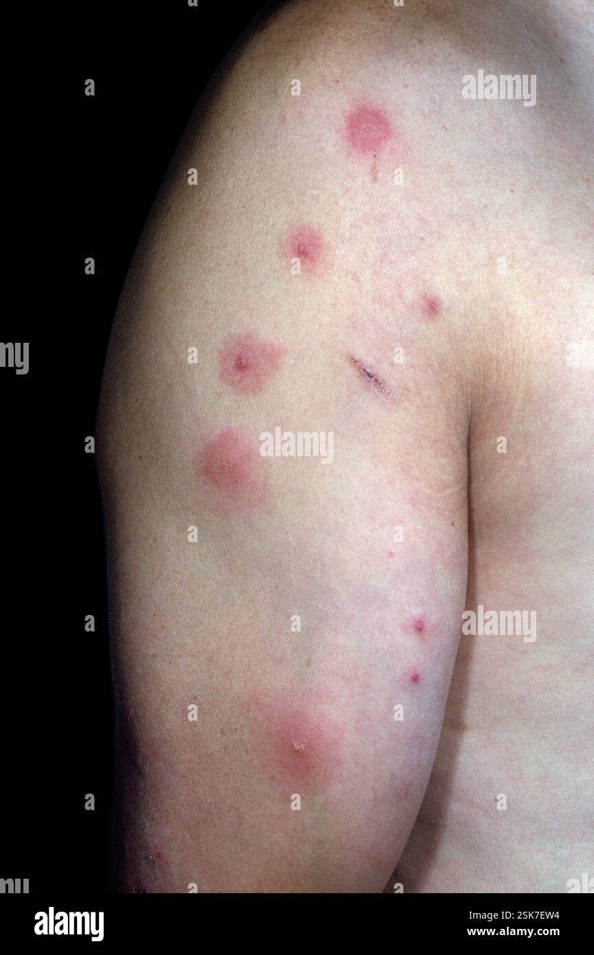 Rashes on the arm of a 34 year old woman caused by pediculosis ...