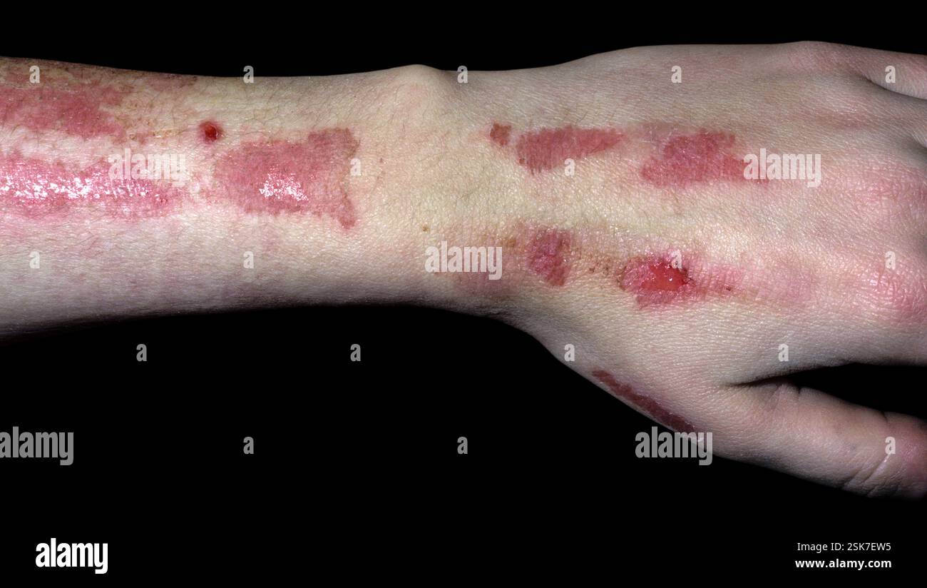 Self inflicted skin lesions on the forearm and hand of a 30 year old ...