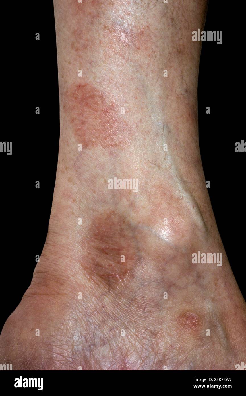 Plaque parapsoriasis lesions on the ankle of a 52-year-old male patient ...