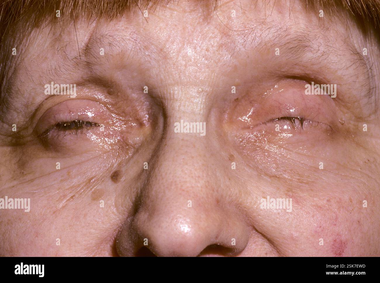 Bullous pemphigoid blisters on the eyelids of a 70 year old woman. This ...