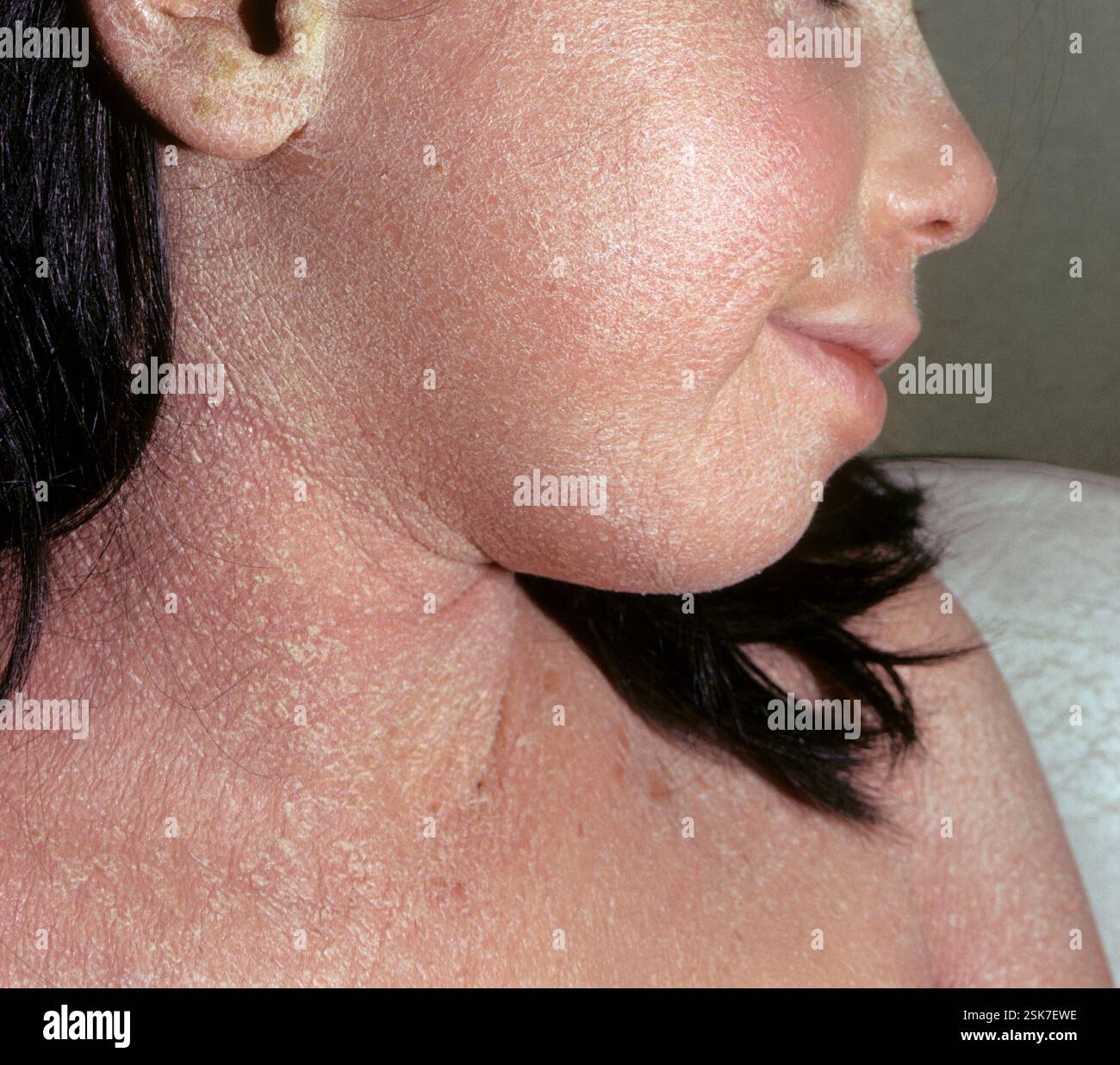 Pityriasis rubra pilaris on the face and neck of an 8 year old patient ...
