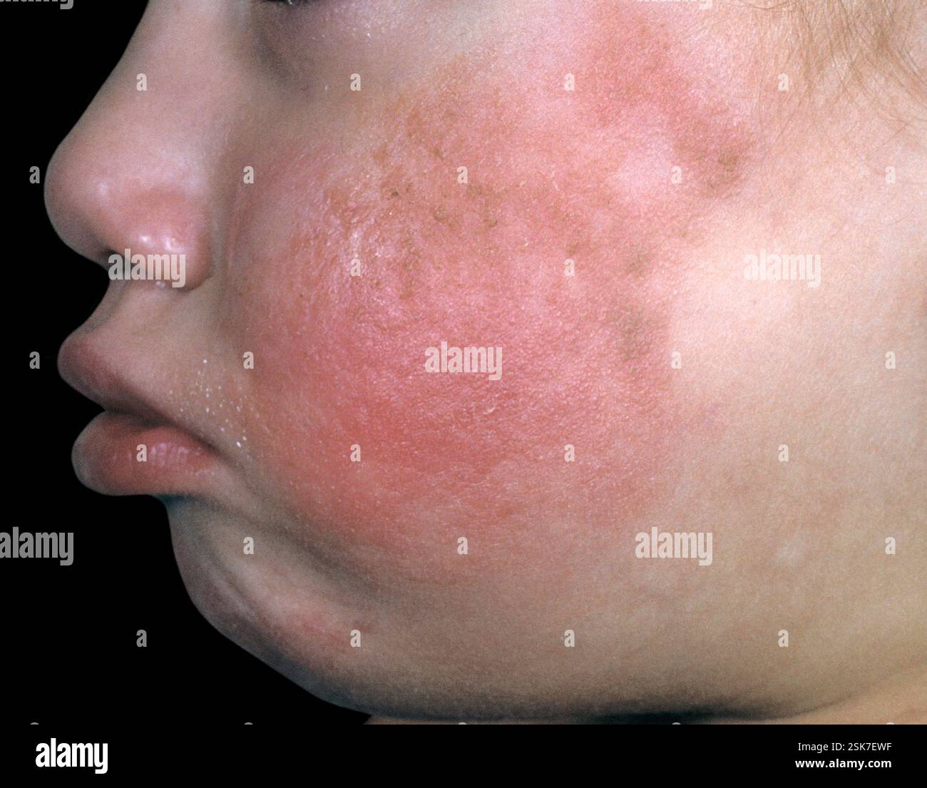 Poikiloderma on the face of a 3 year old girl. This disorder, affects the skin, eyes, bones and ...